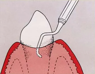 Gum Disease Care - Lee Ann Hovious, D.M.D., P.C.